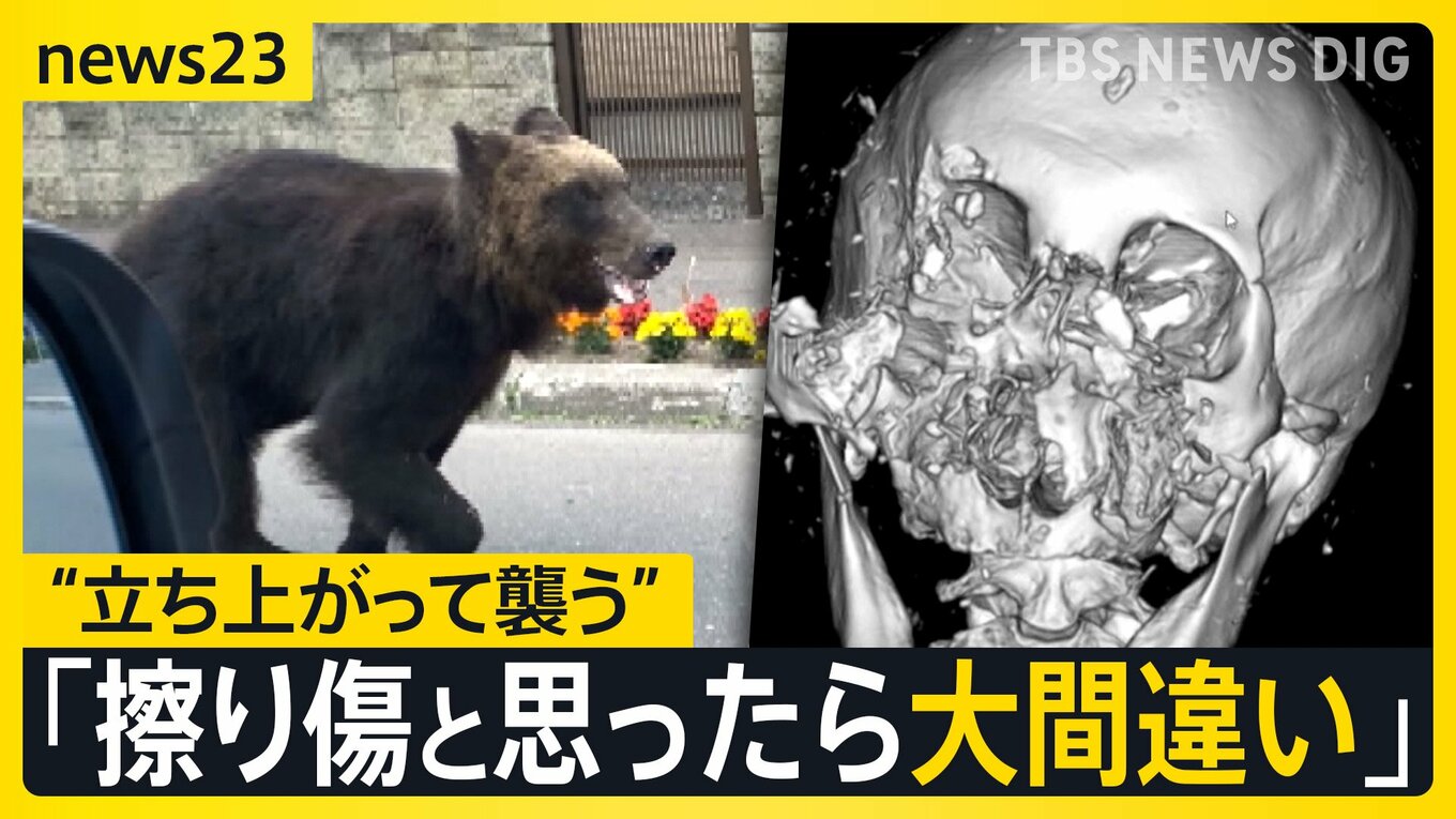 「最初の一撃で肋骨6本折れた」 クマに襲われた男性が警鐘「獣害ではなく災害」 深刻化する被害…老人ホームの裏に“3時間居座り”も【news23】 | TBS NEWS DIG