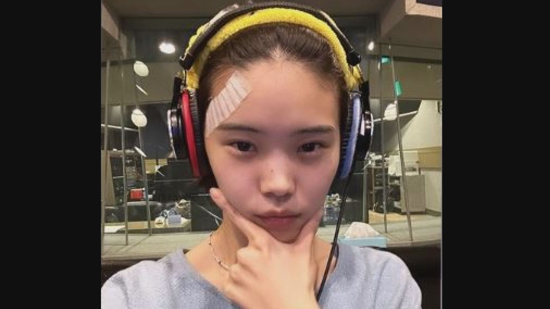 【BiSH アイナ・ジ・エンドさん】復帰した姿を公開「人間の生命力ってすごいです」 | TBS NEWS DIG フォトギャラリー