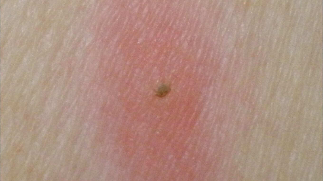 “ほくろ”の正体はマダニだった 皮膚に「黒い点」下手したら死ぬ…感染症SFTSのリスクと対策 | TBS NEWS DIG フォトギャラリー